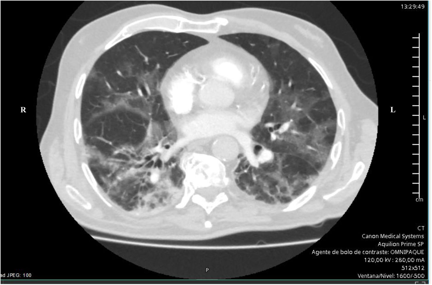 Síndrome de platipnea-ortodeoxia en neumonía bilateral por SARS-CoV-2 ...