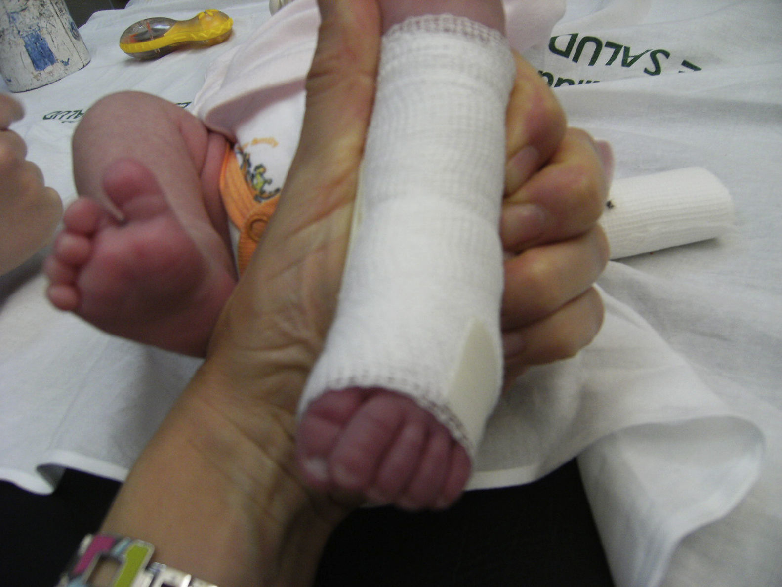 Tratamiento del pie metatarso aducto con el método de vendajes ...