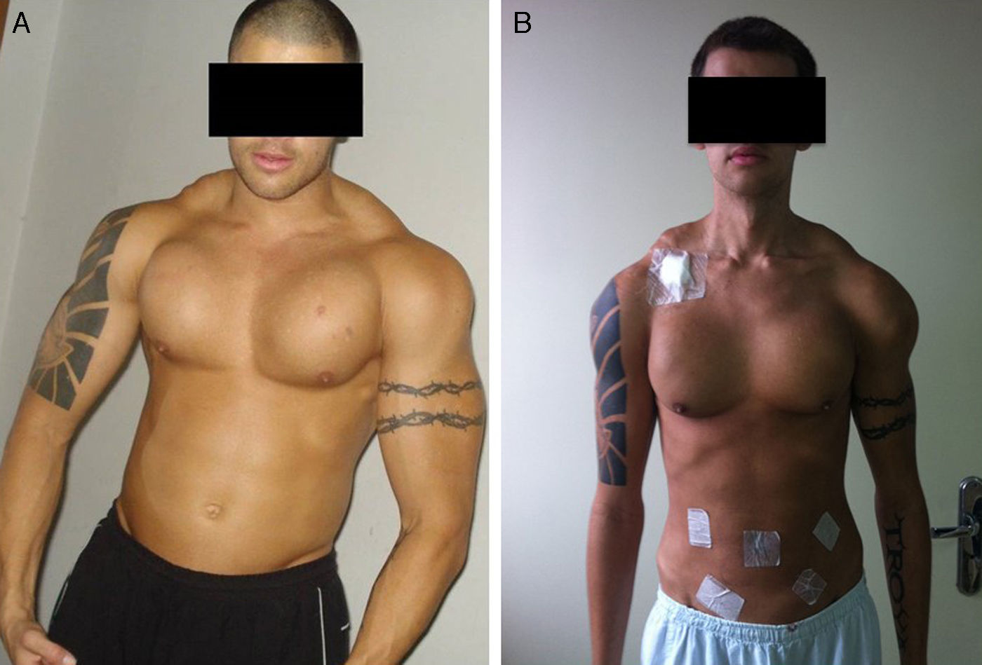 before after steroids