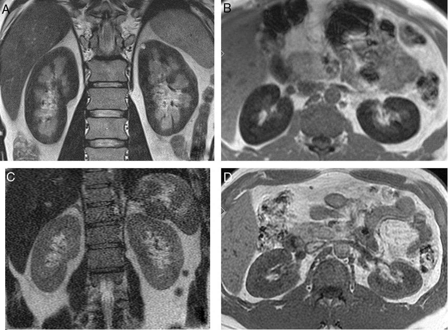 Rol de la resonancia magnética renal en la monitorización del ...