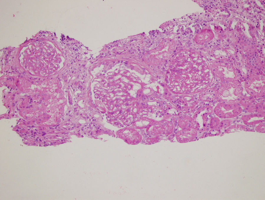 C3 glomerulonephritis accompanied with lupus nephritis | Nefrología