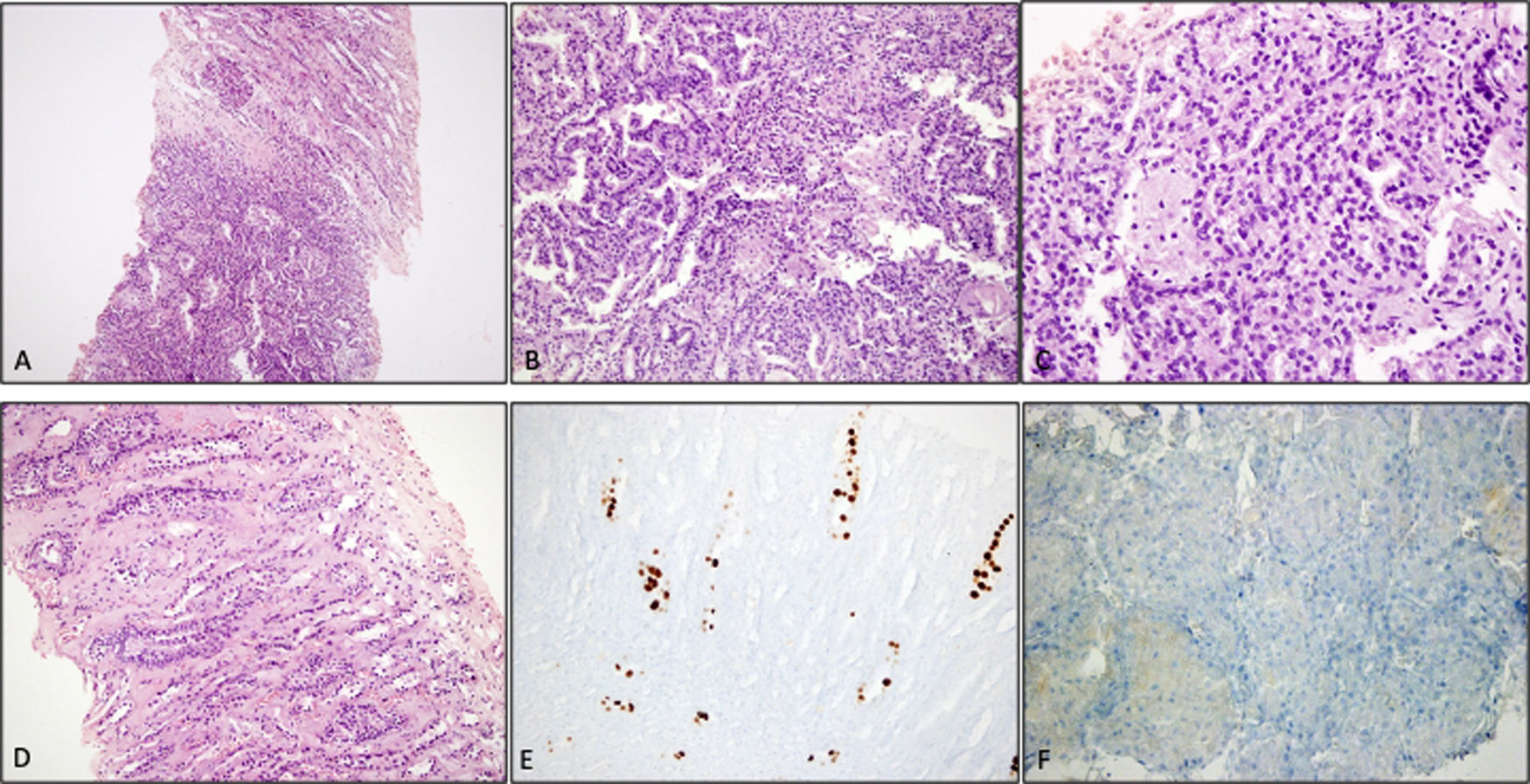 Expression of JC virus in a kidney transplant recipient with renal cell ...