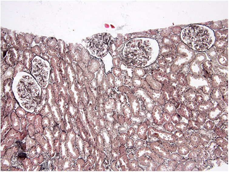 Coexistence of steroid-resistant minimal change disease and familial ...