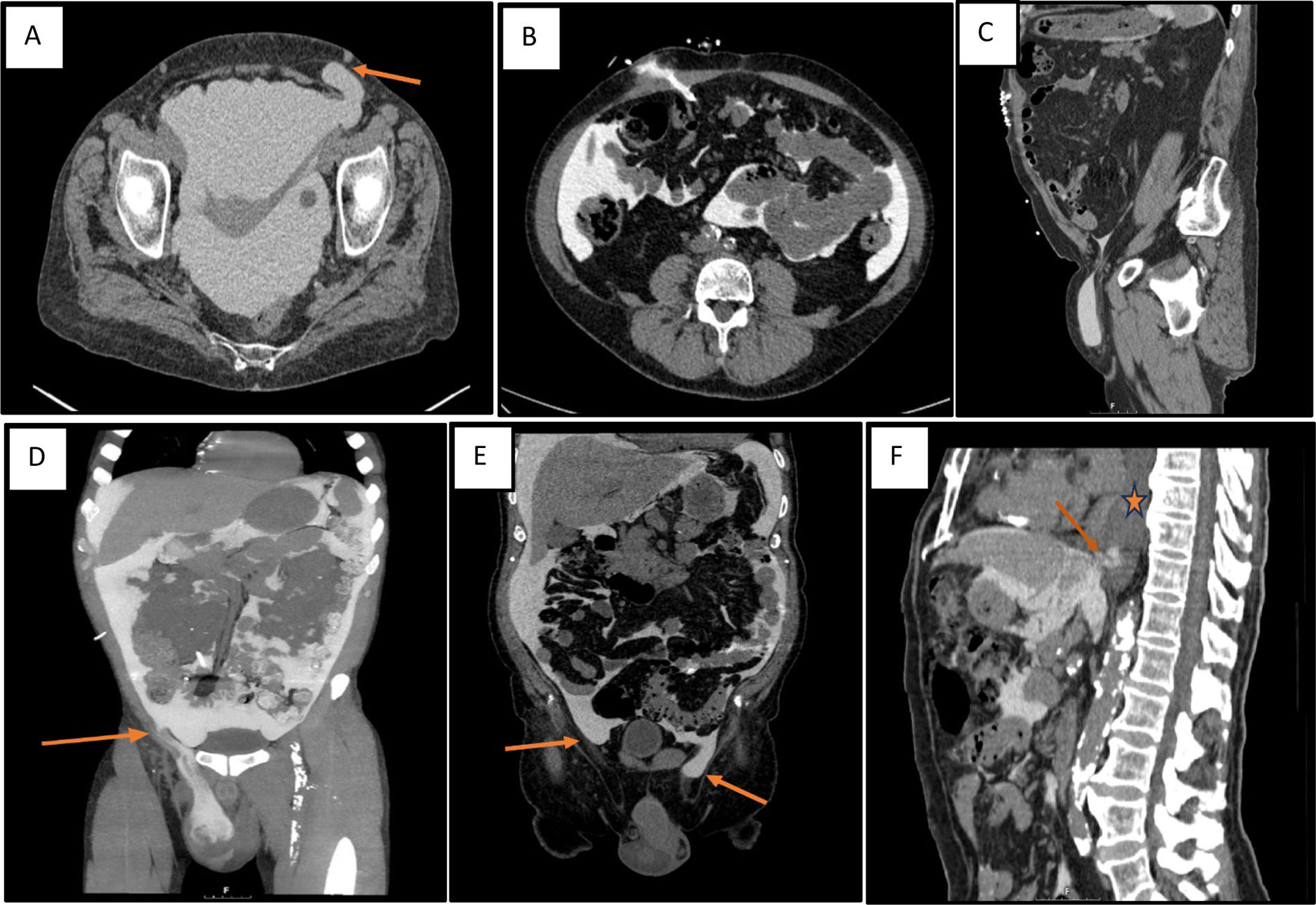 TC-peritoneografía: técnica diagnóstica clave en diálisis peritoneal ...