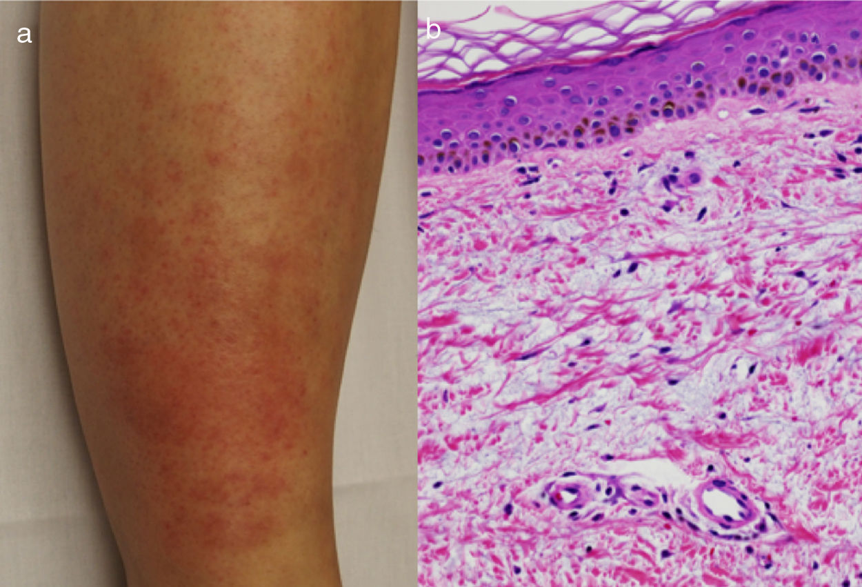 Mixedema pretibial en enfermedad de Graves | Atención Primaria