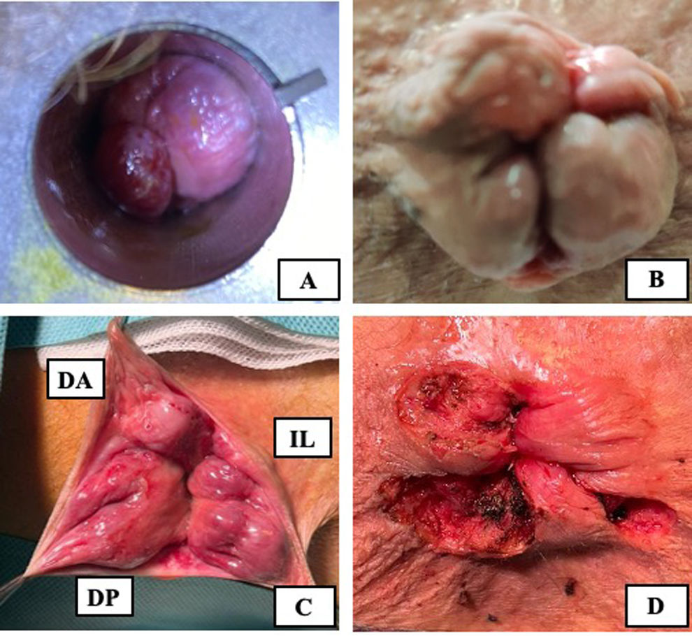 hemorroides internas