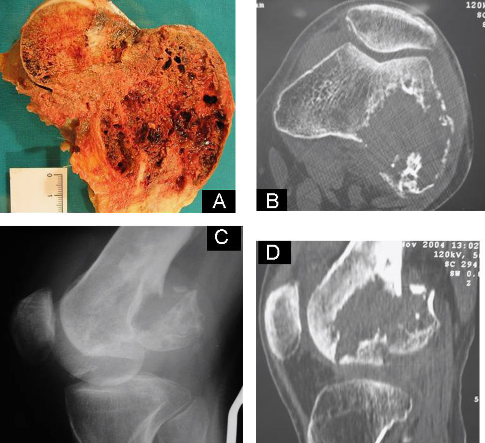 Tumor óseo de células gigantes en paciente con infección por el virus ...