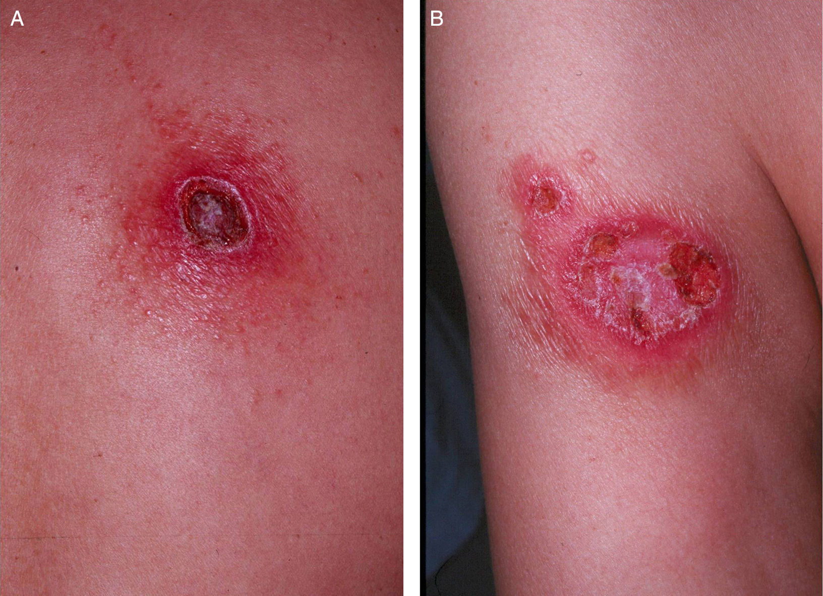 Lesiones ulceradas de larga evolución en varón inmunocompetente ...