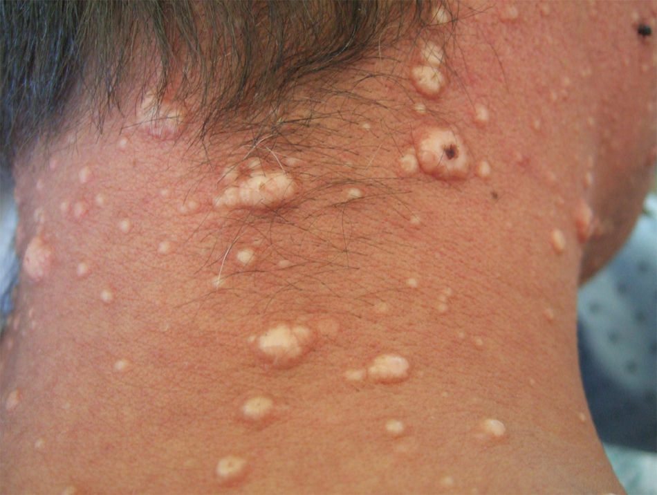 granos en el cuerpo por vih