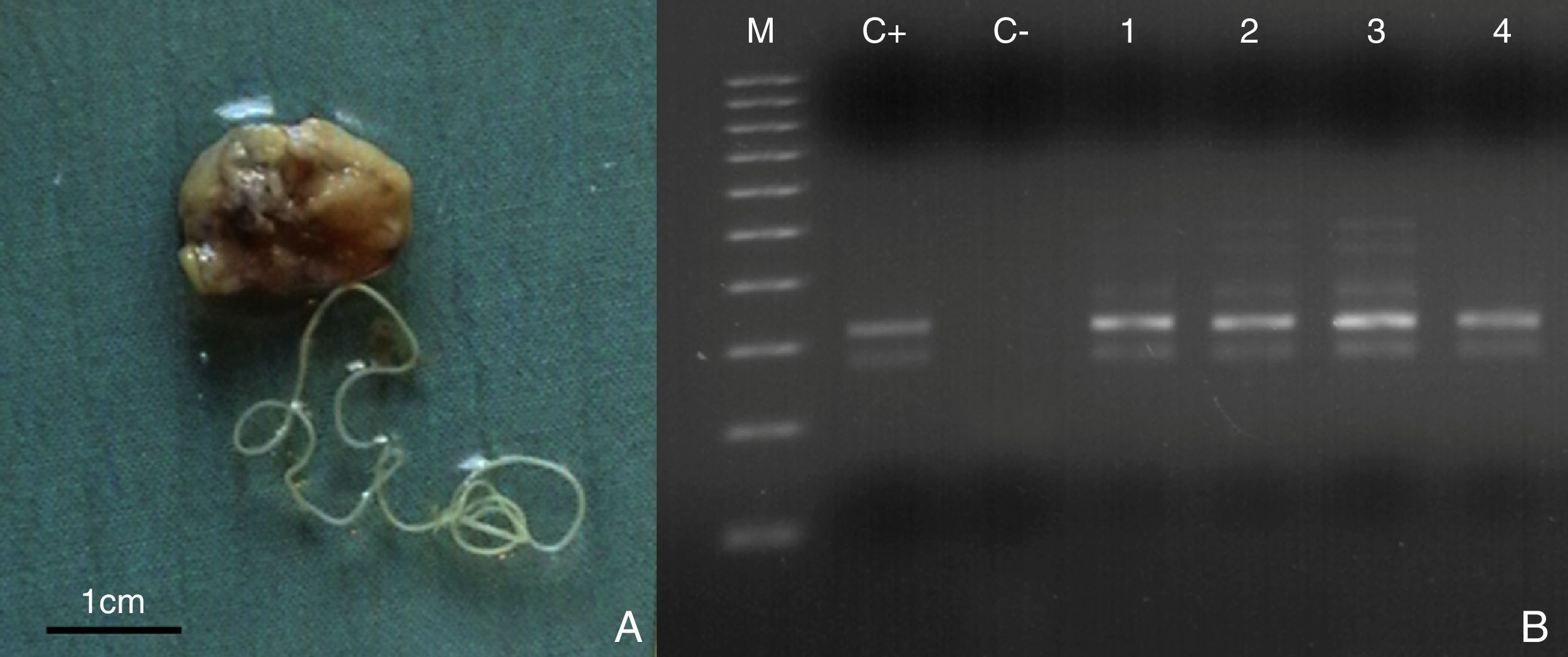 worms in breast tissue