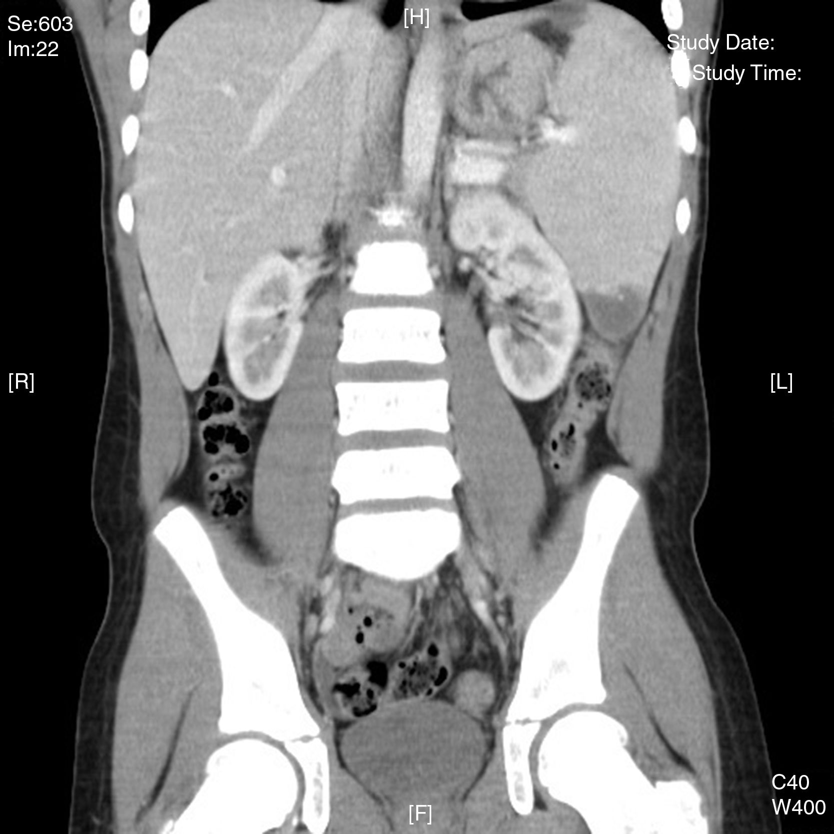 Infarto esplénico debido a una infección común | Enfermedades ...