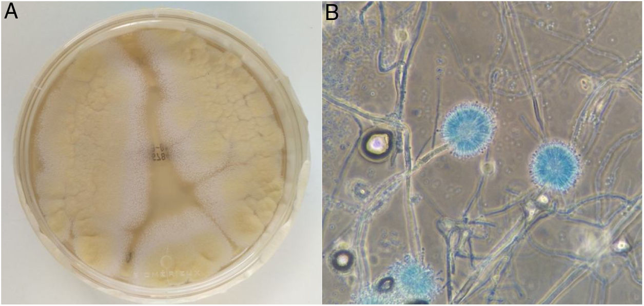 Primer caso de rinosinusitis fúngica no invasiva por Aspergillus ...