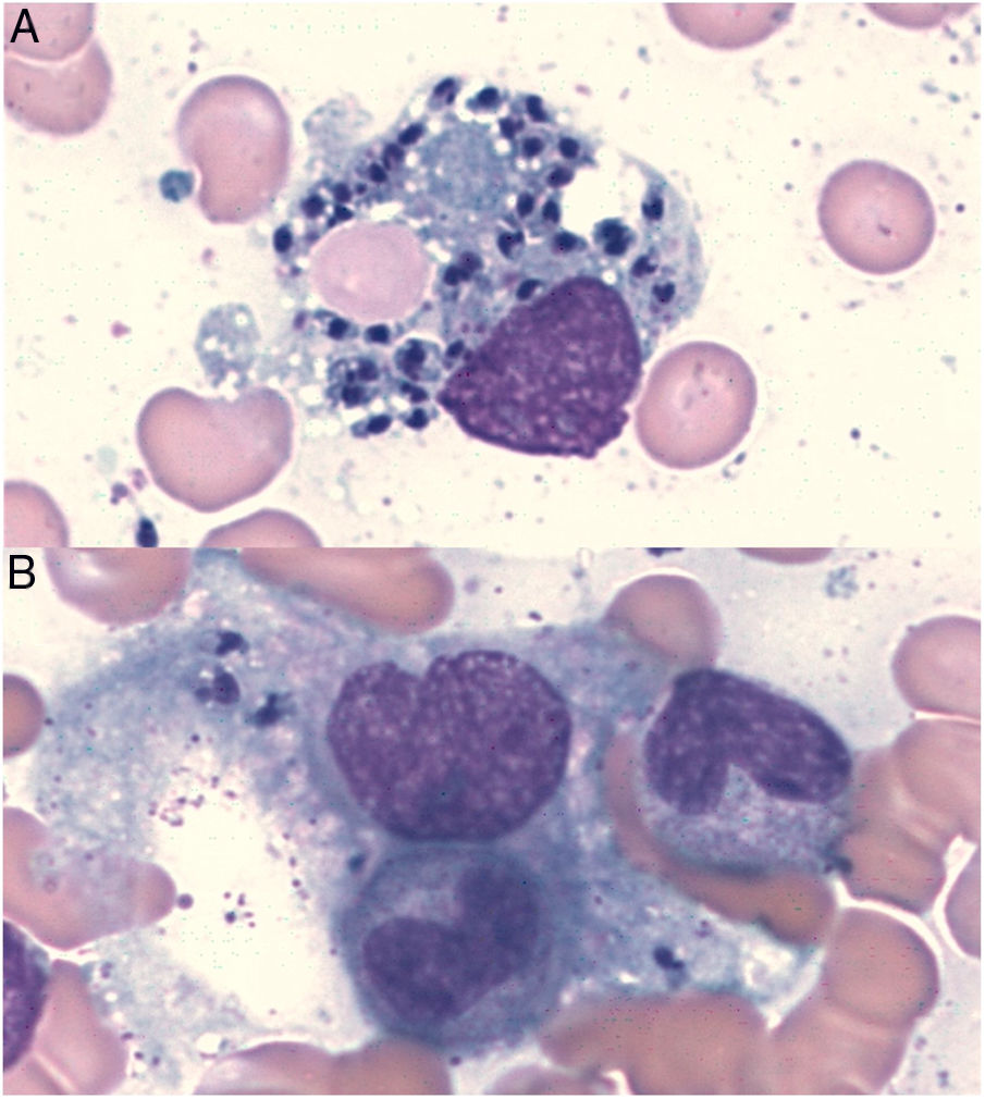 leishmania bone marrow