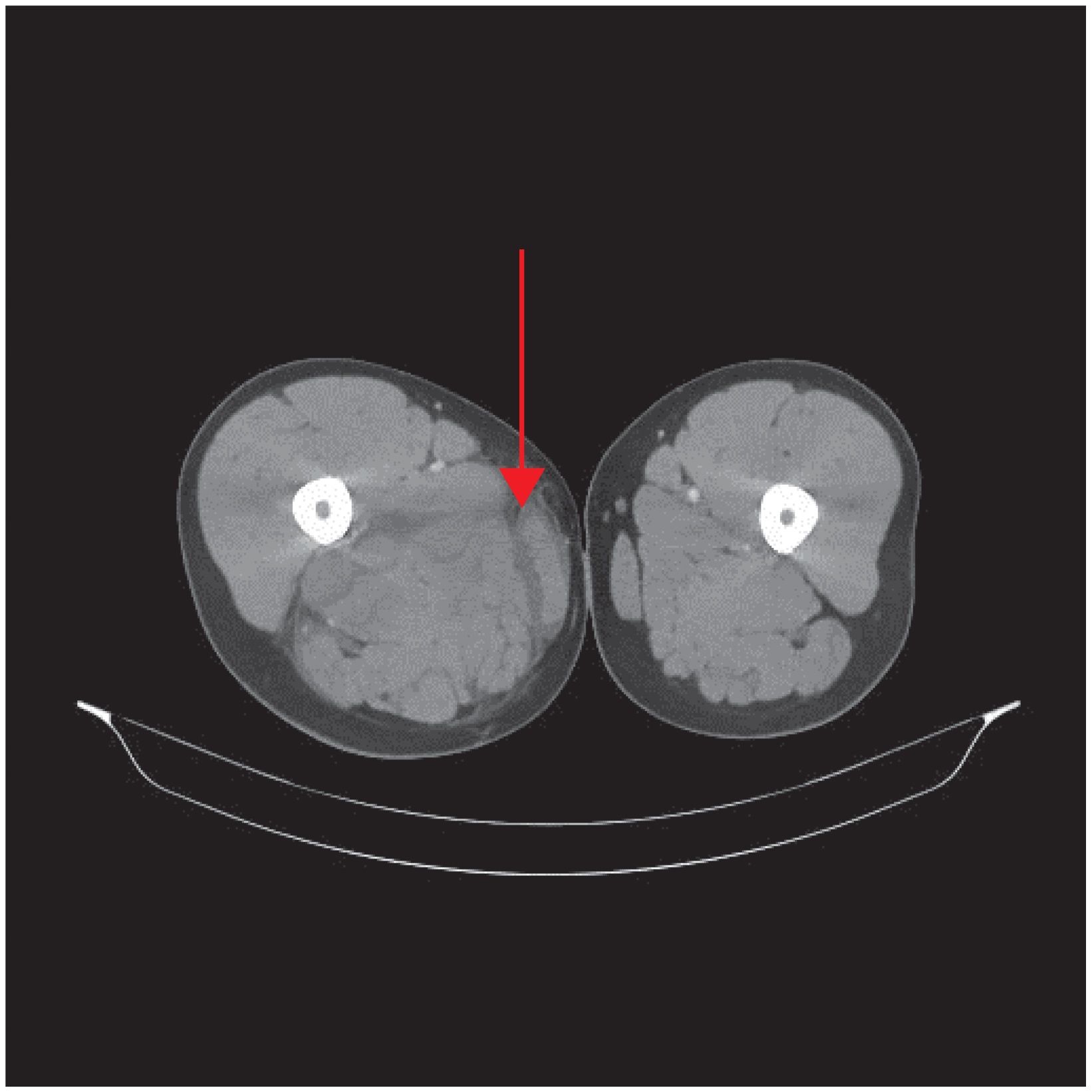 Desenlace inesperado de amigdalitis pultácea en persona joven sin ...