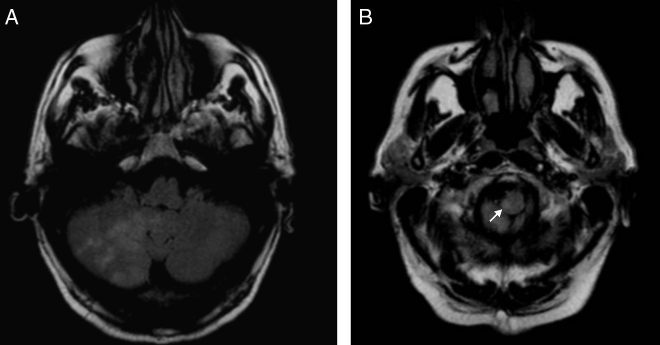 Síndrome de Opalski: una variante del síndrome medular lateral | Neurología