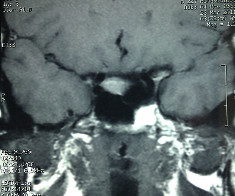 Cefalea tipo SUNCT (Short-lasting unilateral neuralgiform headache ...