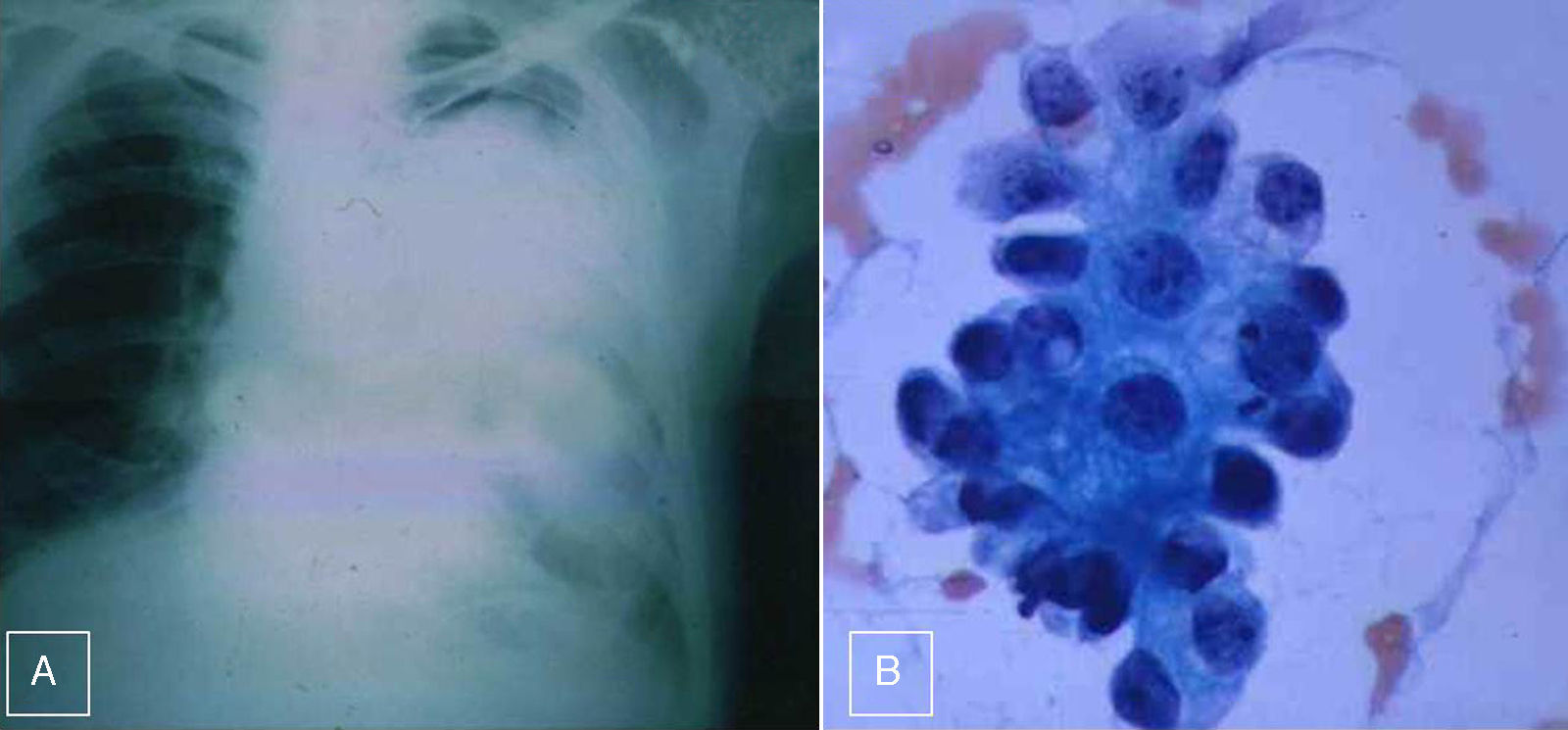 Diaforesis recurrente, estado confusional agudo y mesotelioma pleural ...