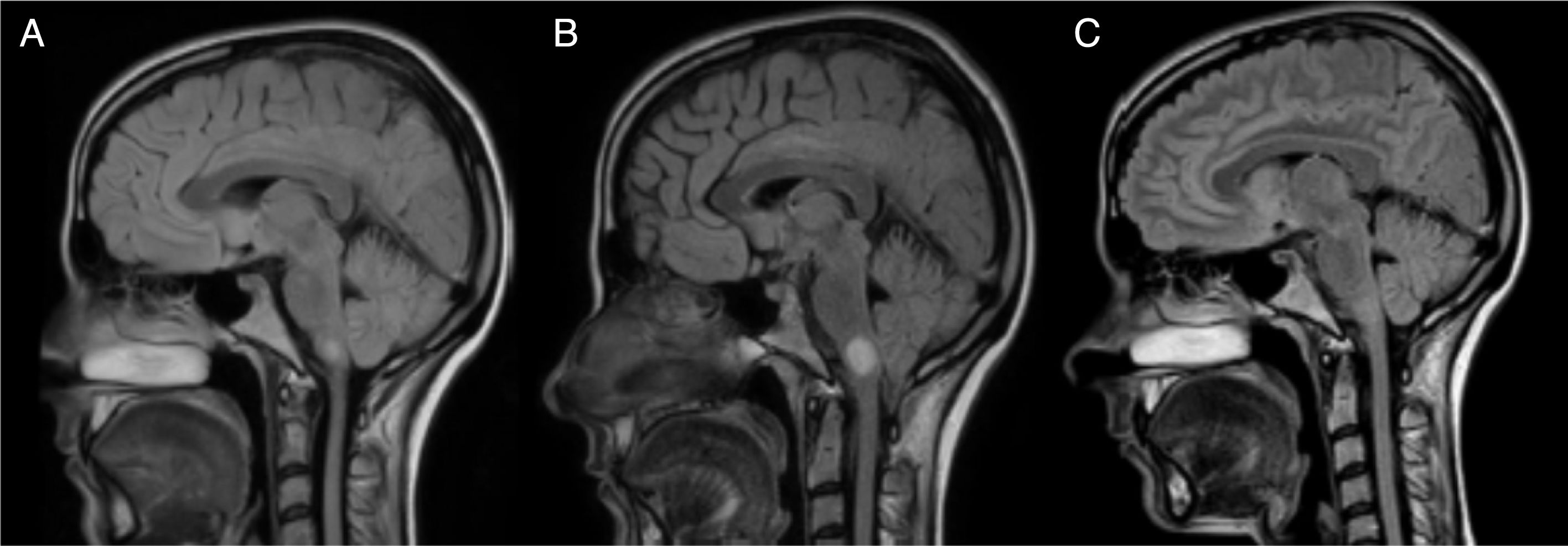 Shock cardiogénico en síndrome clínico aislado | Neurología