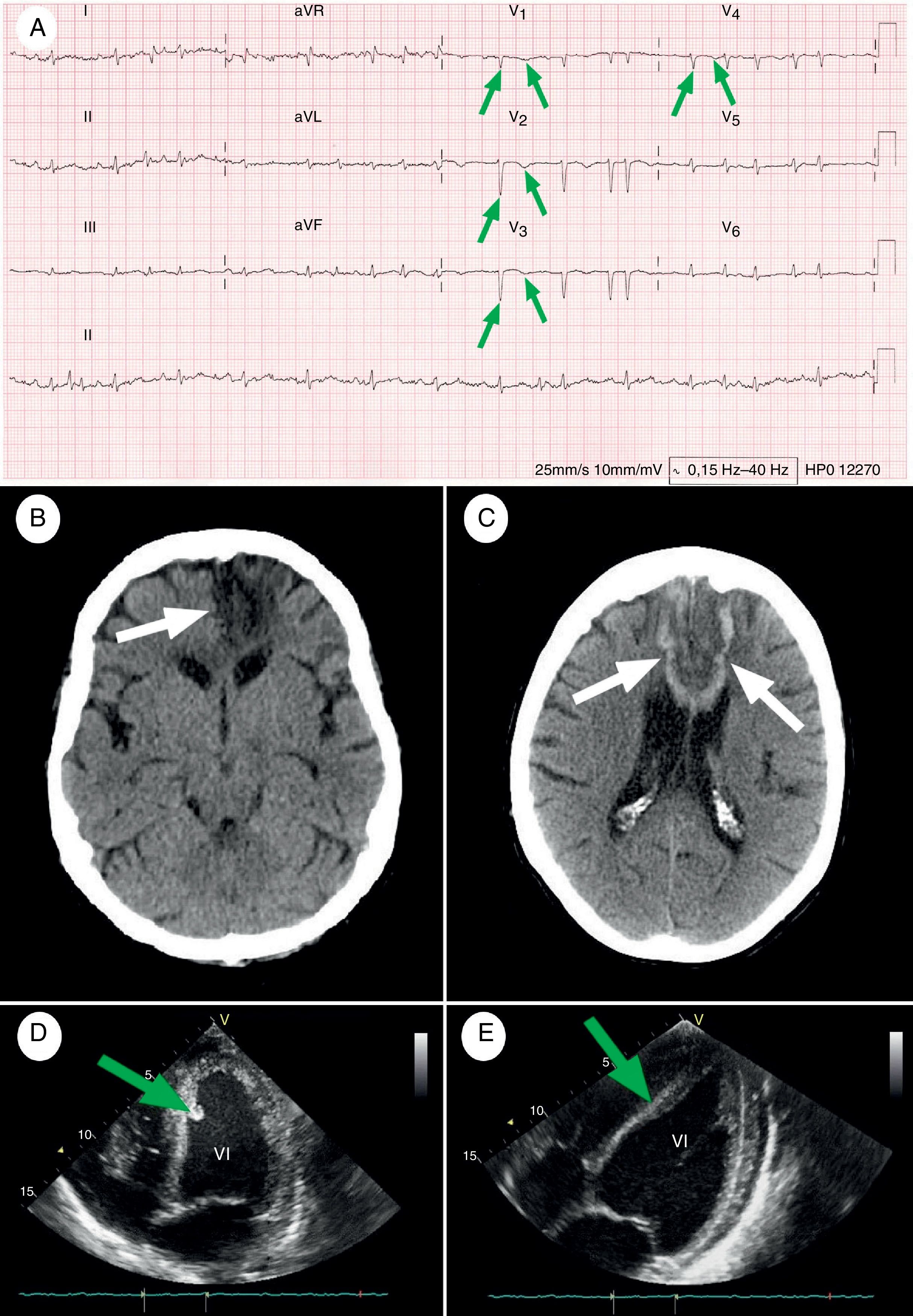 Infarto agudo de miocardio asociado con ictus subagudo bilateral ...
