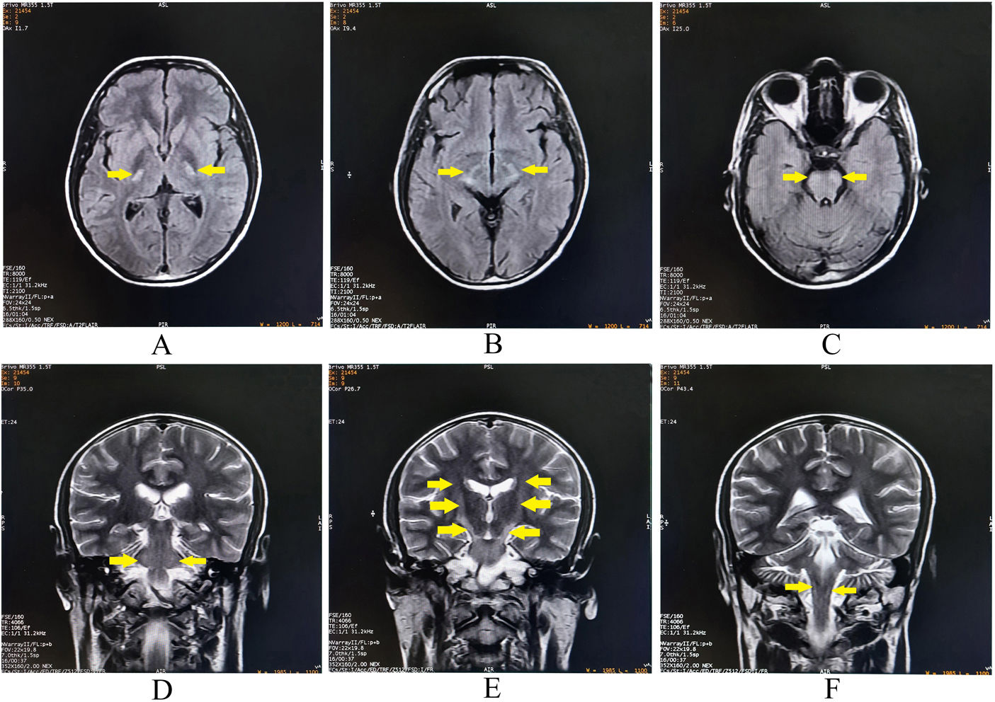 amygdala hyperintensity mri