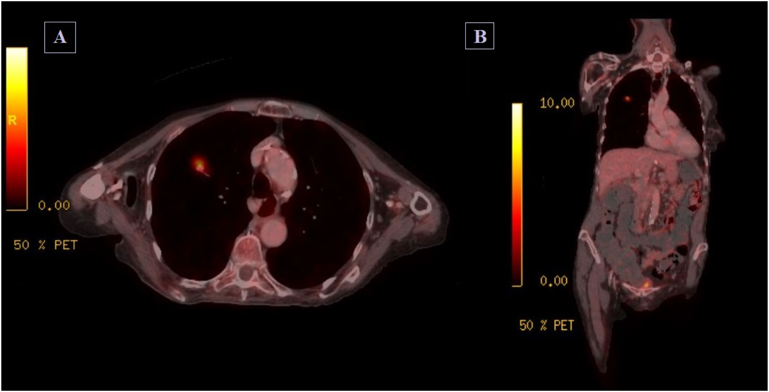 “Flail arm syndrome” with anti-Hu antibodies | Neurología