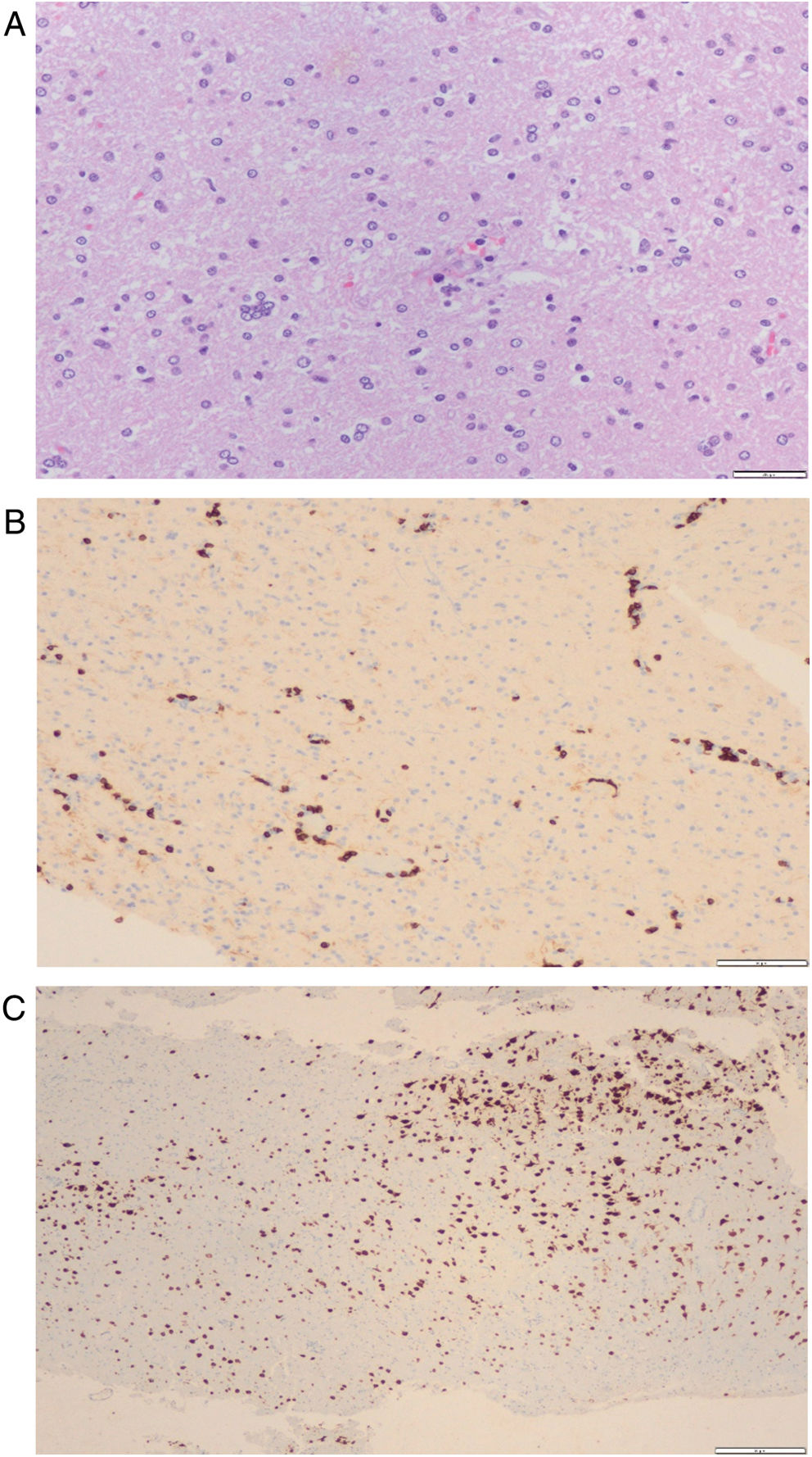 Late-onset Rasmussen encephalitis: 3 illustrative cases and a review of ...