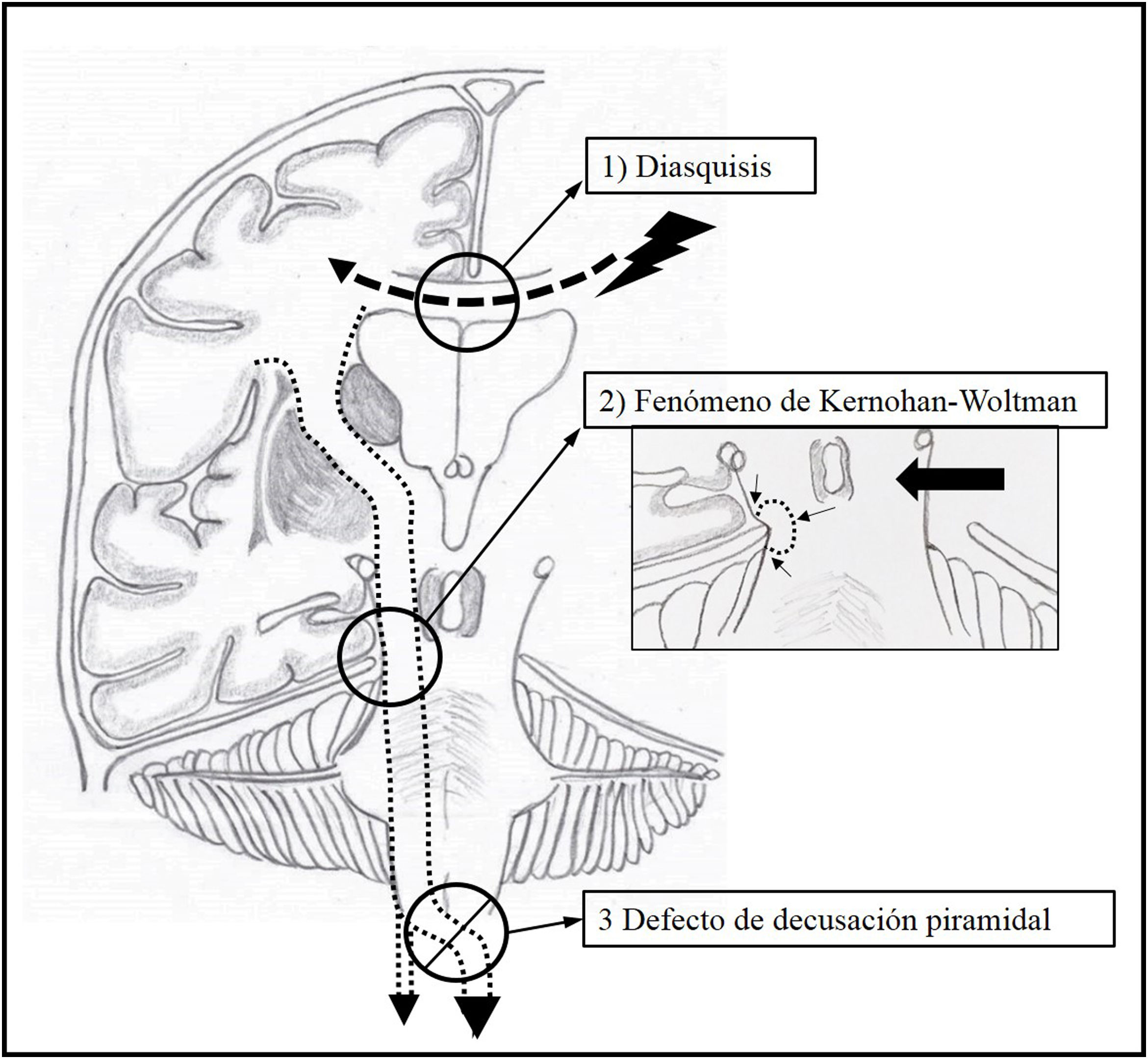 Fenómeno de Kernohan-Woltman: ¿un cuadro neurológico excepcional ...