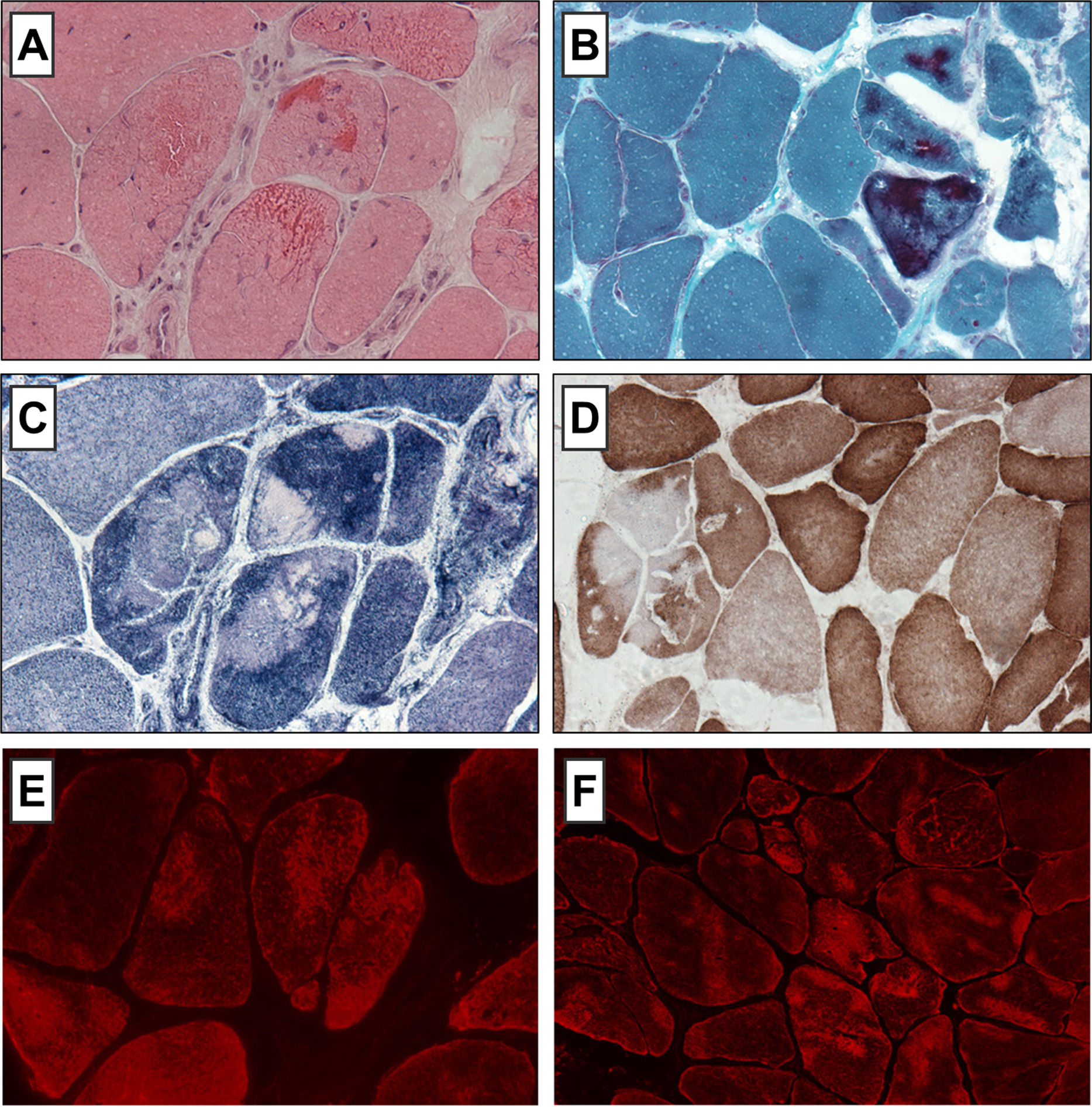 Novel DES mutation presenting with isolated restrictive respiratory ...