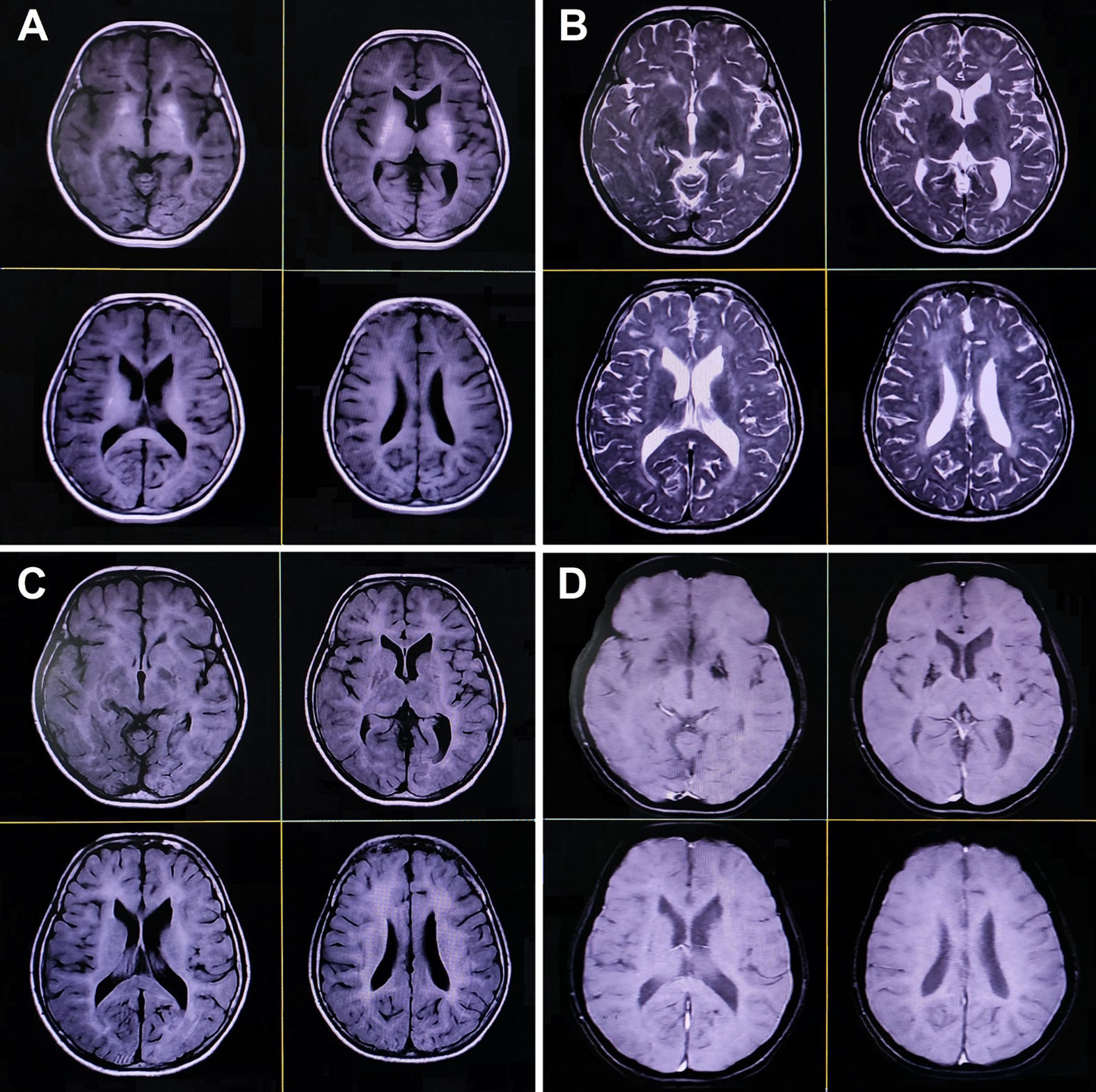 Cockayne syndrome B with axonal sensorimotor polyneuropathy caused by a ...