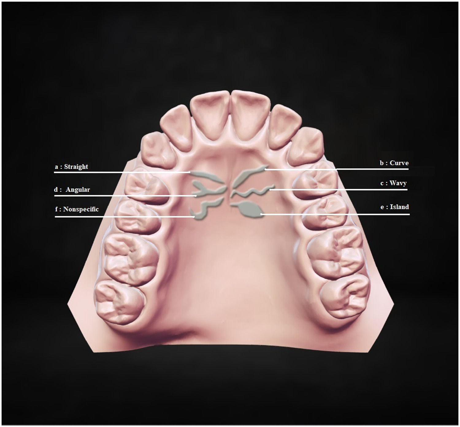 Is palatal rugae a specific marker of dysmorphogenesis in patients with ...