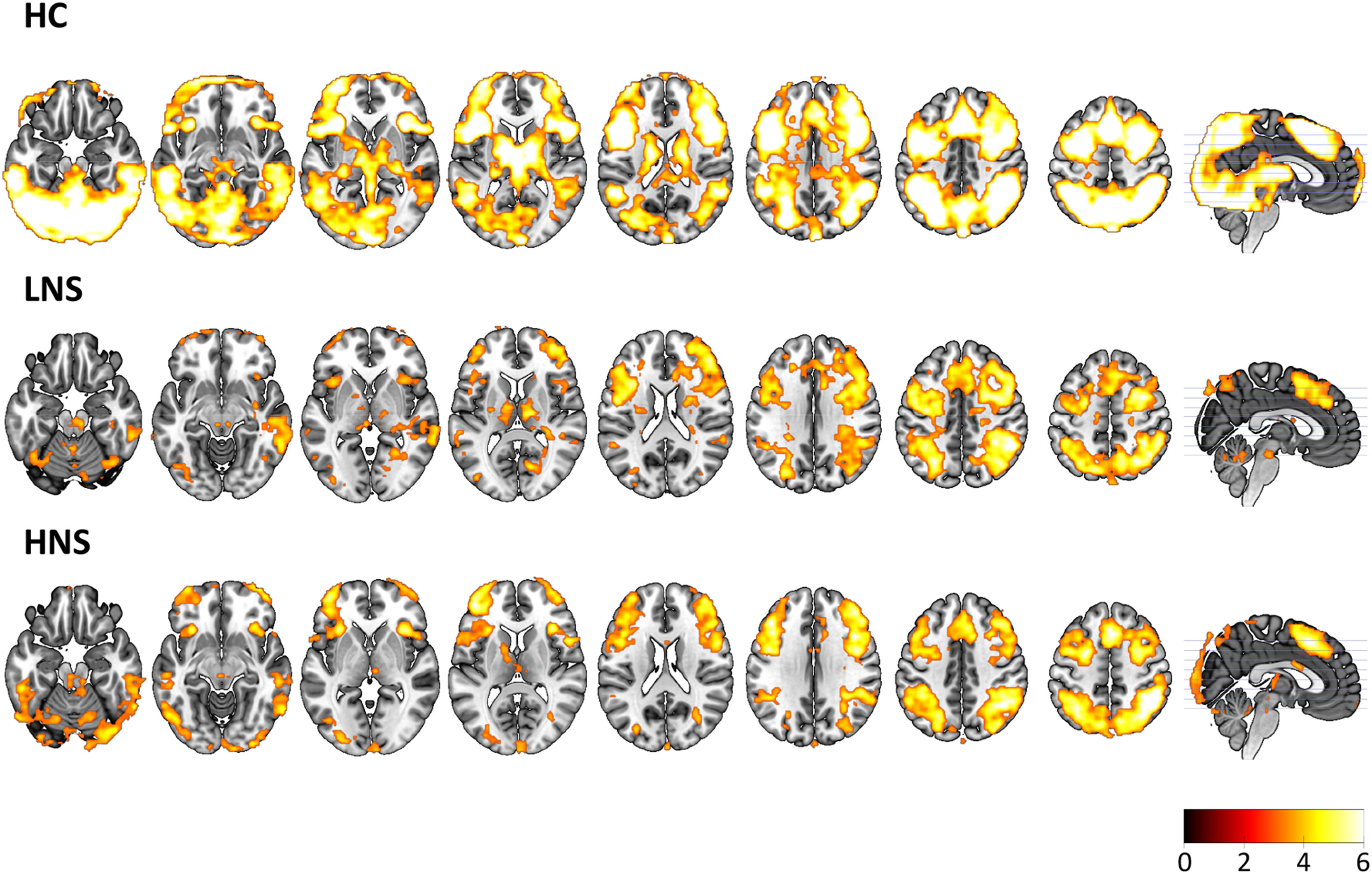Functional brain imaging of negative symptoms in schizophrenia: further ...