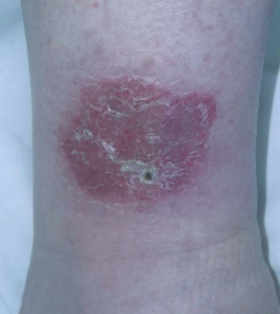 Placa eritematoescamosa única | Piel. Formación continuada en dermatología