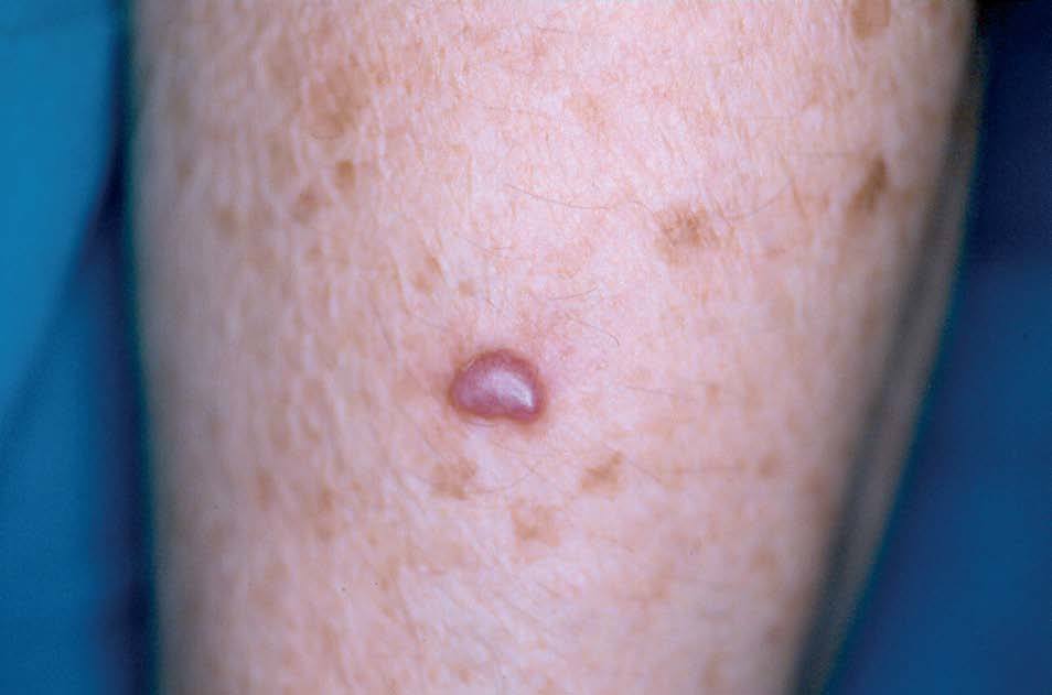 Nódulo eritemato-violáceo en el antebrazo | Piel. Formación continuada ...