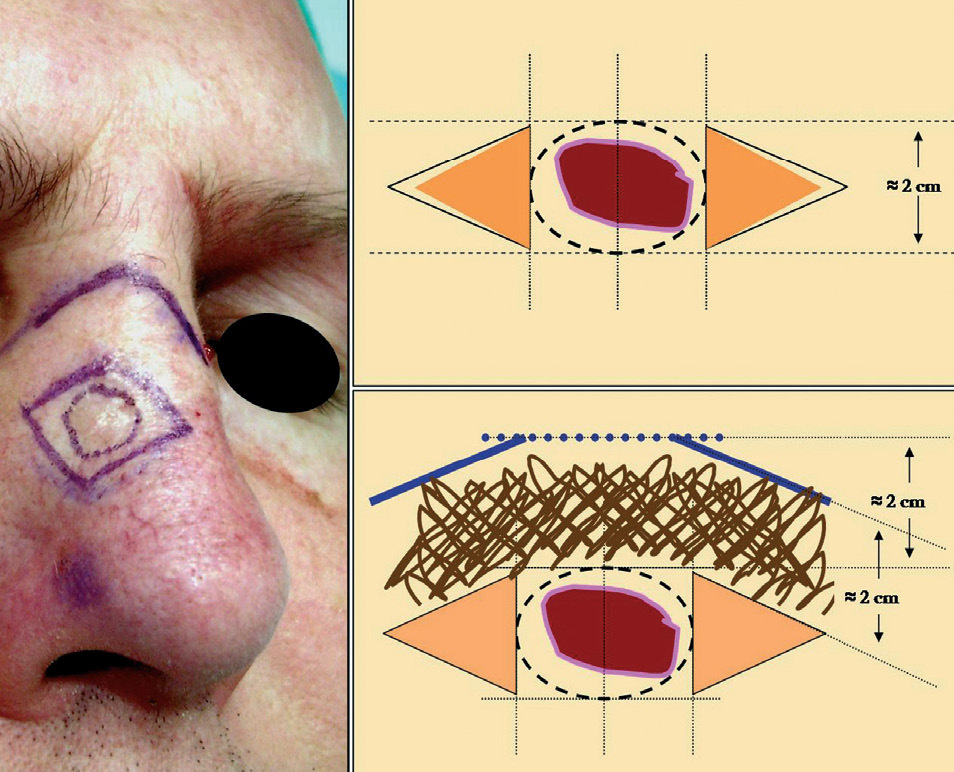 Colgajo bipediculado de avance para la corrección de defectos del dorso ...