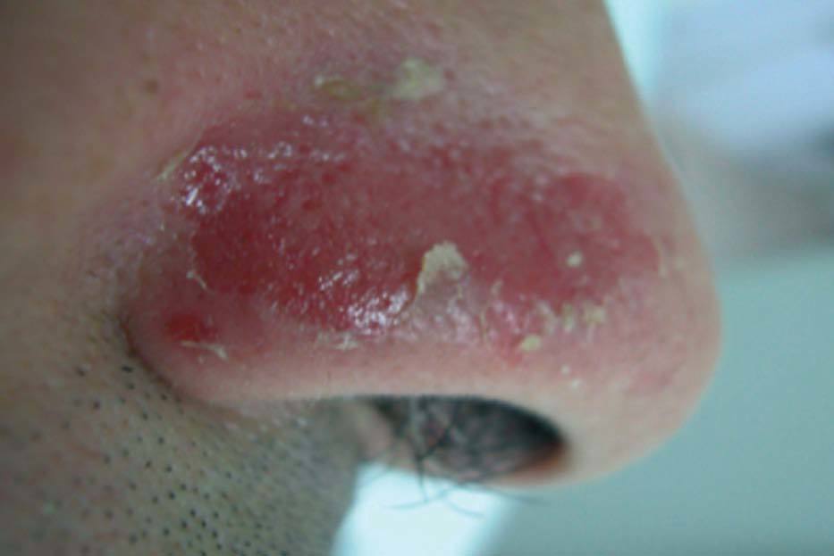 Lesión erosiva en el ala nasal | Piel. Formación continuada en dermatología
