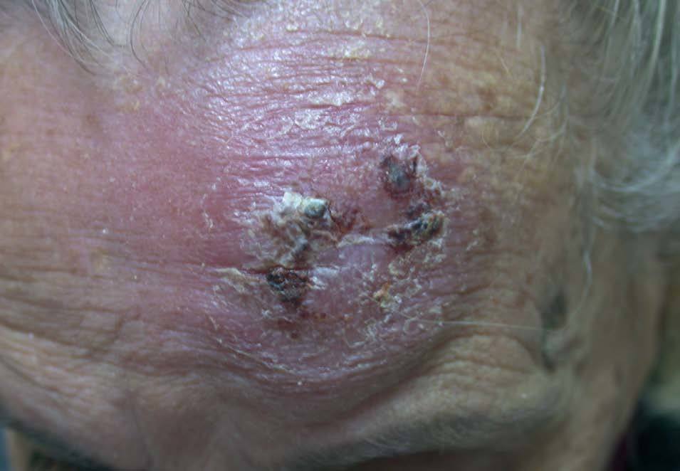 Placa eritematosa e hiperqueratósica | Piel. Formación continuada en ...