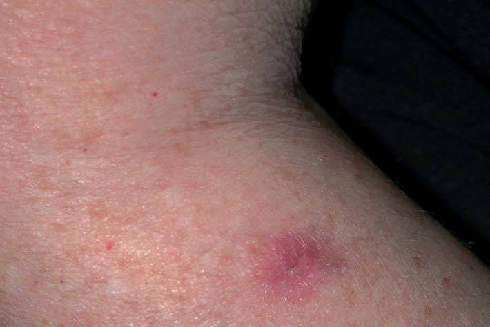 Mácula eritematosa en el antebrazo | Piel. Formación continuada en ...