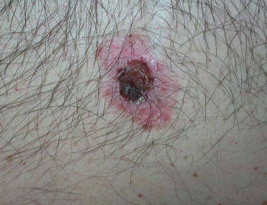 Pápula purpúrica con halo equimótico | Piel. Formación continuada en ...