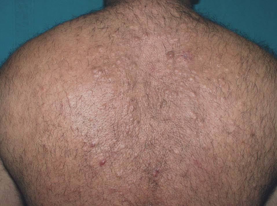 Esclerosis cutánea en parte alta de la espalda | Piel. Formación ...