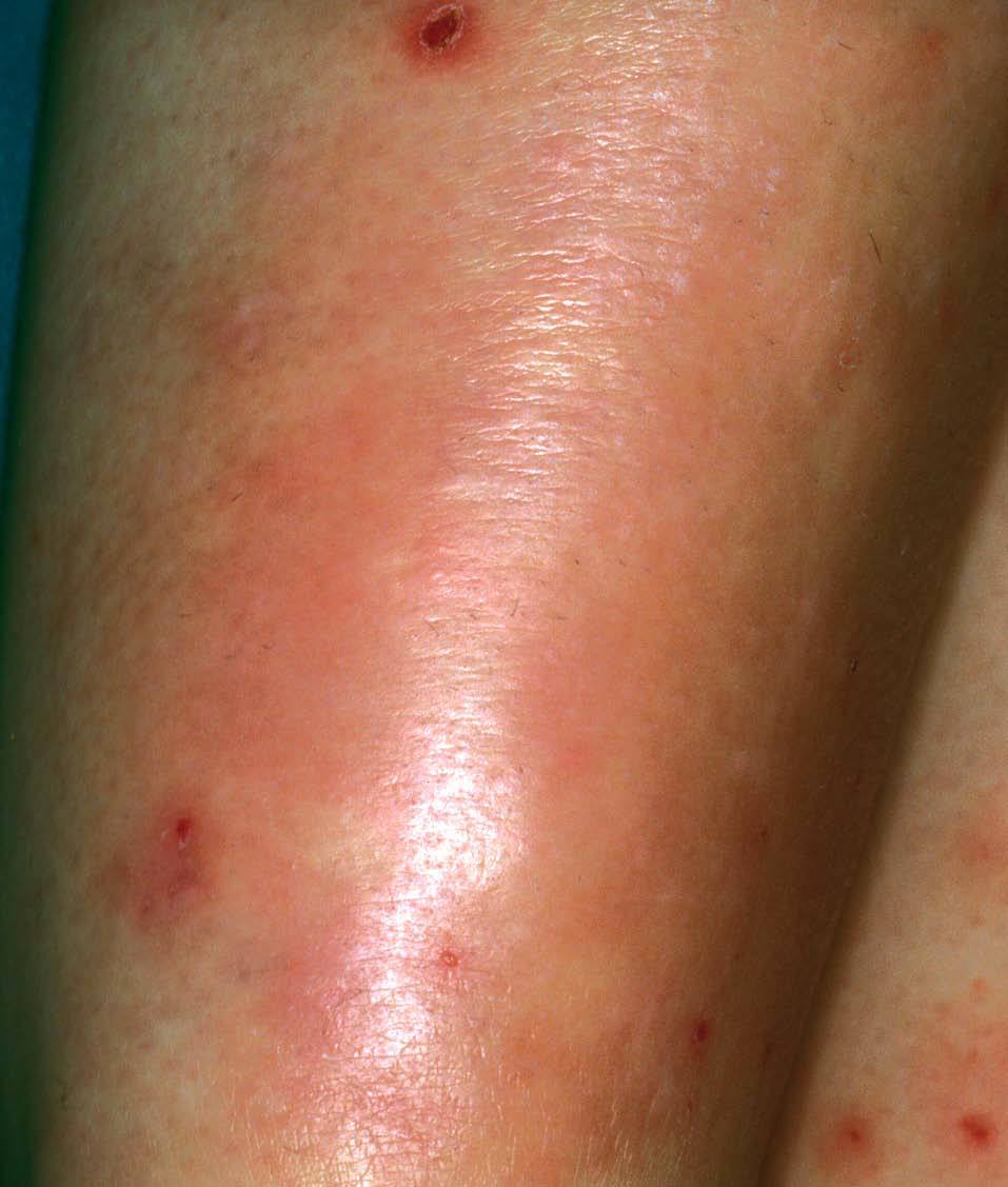 Mixedema pretibial | Piel. Formación continuada en dermatología