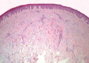Mixedema pretibial | Piel. Formación continuada en dermatología