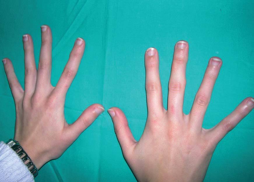 Lesiones nodulares en los dedos de las manos | Piel. Formación ...