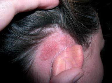 Placa marrón retroauricular | Piel. Formación continuada en dermatología