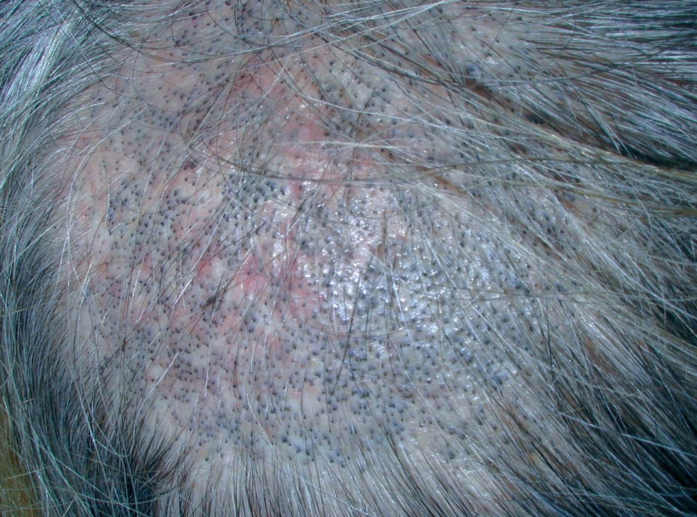 Placas alopécicas en un adulto | Piel. Formación continuada en dermatología