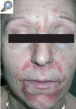 Acrodermatitis enteropática en una mujer adulta perimenopáusica | Piel ...