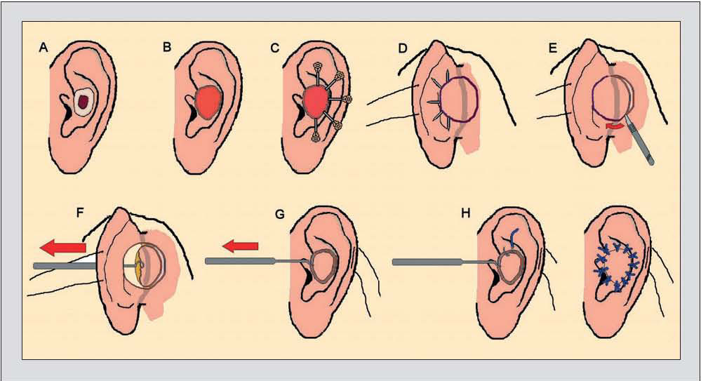 Reconstrucción de la concha auricular mediante un colgajo en isla ...