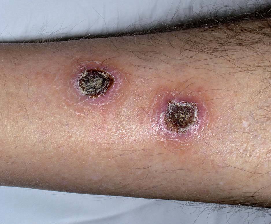 Leishmaniasis cutánea múltiple: presentación de tres casos | Piel ...