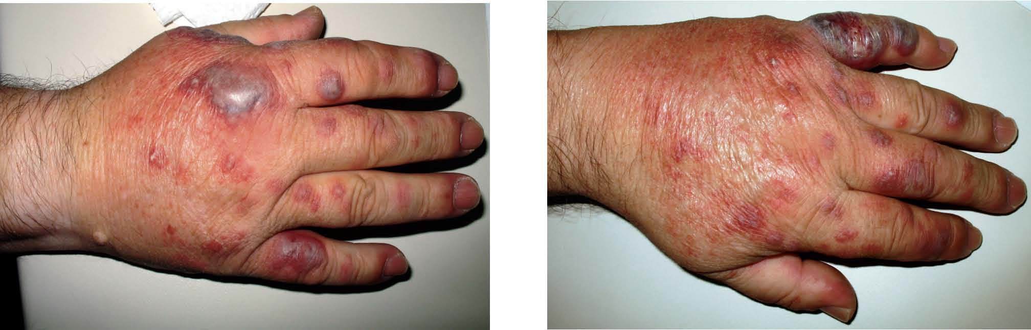 Pústulas y ampollas hemorrágicas en el dorso de las manos | Piel ...