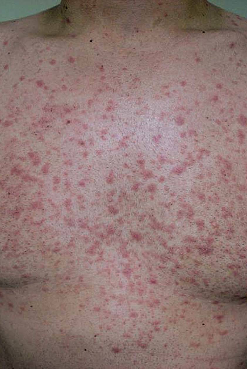 Exantema en paciente con fiebre | Piel. Formación continuada en ...