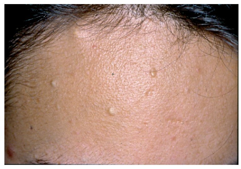 Esteatocistomas múltiples y alteraciones ungueales | Piel. Formación ...